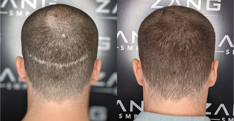 SMP for Aging Hair: Benefits & Considerations | Zang SMP