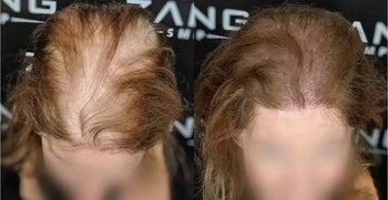 Female Pattern Baldness in Your 20s: Key Insights – Zang SMP