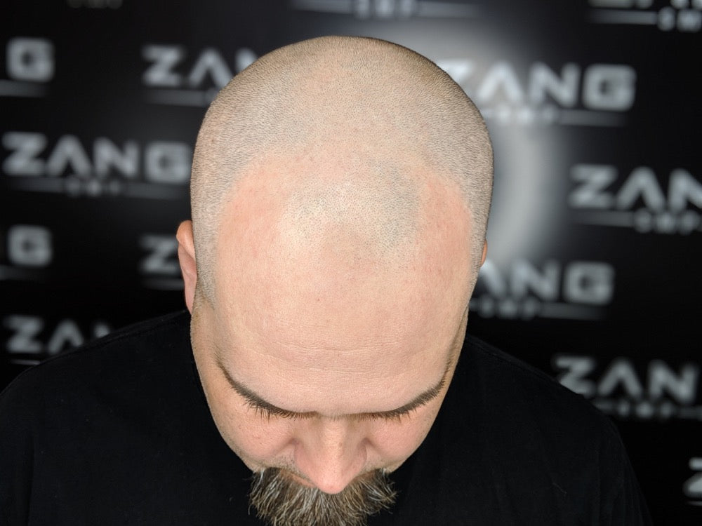 Gallery: Achieving the Softest Hairlines with SMP – Zang SMP
