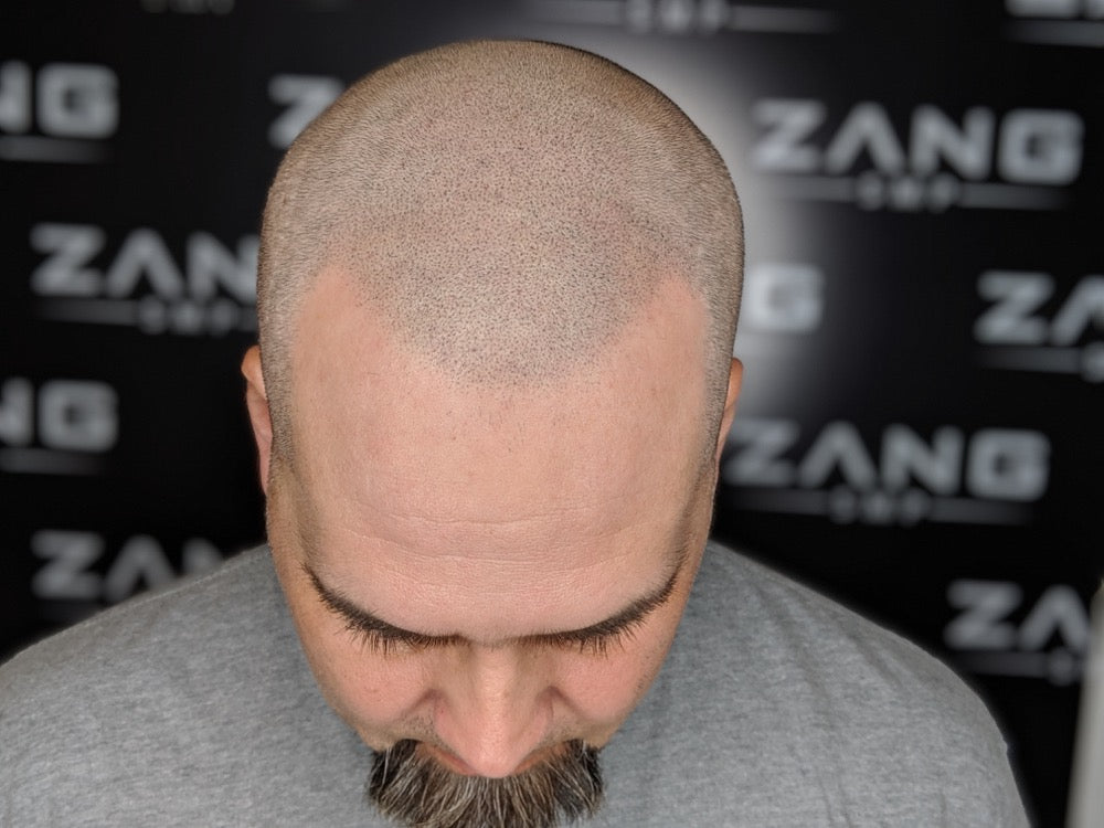 Gallery: Achieving the Softest Hairlines with SMP – Zang SMP